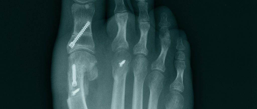 Bunion Surgery – Metatarsal Osteotomy - Cambridge Foot and Ankle Clinic